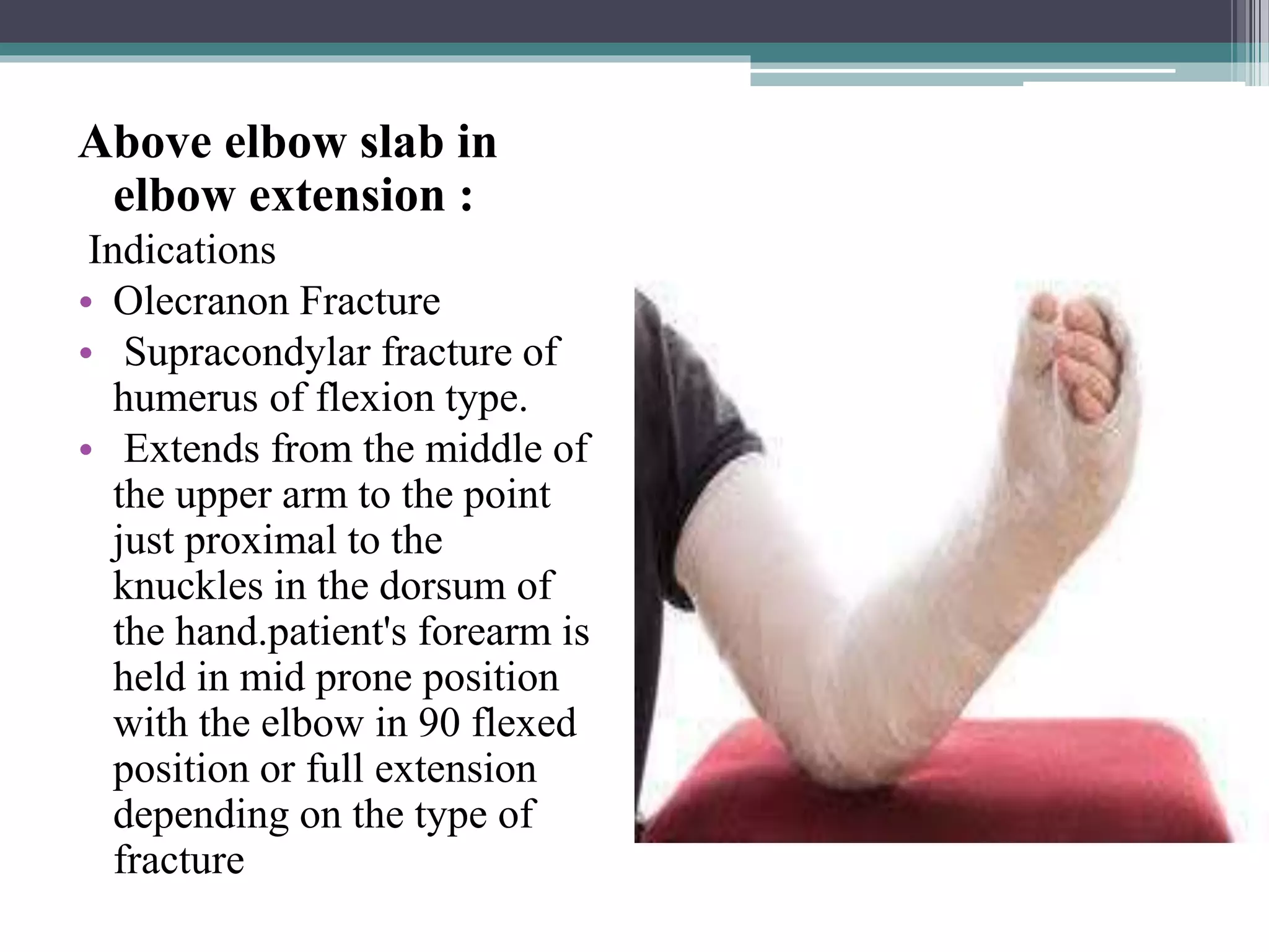 Plaster of paris ,synthetic casts and Functional cast bracing | PPTX