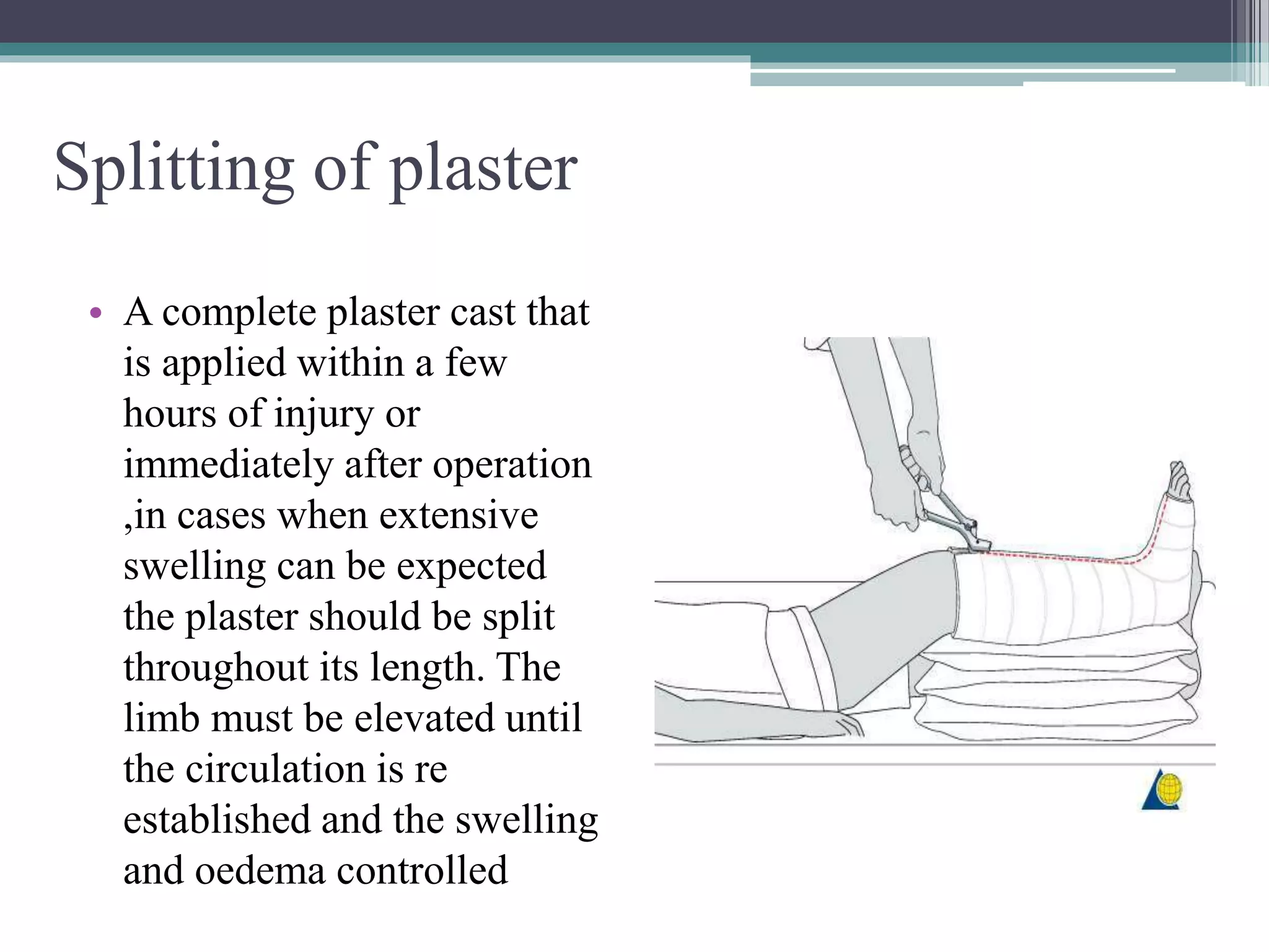 Plaster of paris ,synthetic casts and Functional cast bracing | PPTX