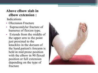 Plaster of paris ,synthetic casts and Functional cast bracing | PPTX