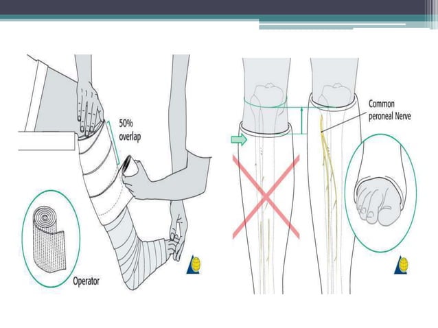 Plaster of paris ,synthetic casts and Functional cast bracing | PPTX
