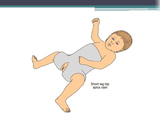 Plaster of paris ,synthetic casts and Functional cast bracing | PPTX