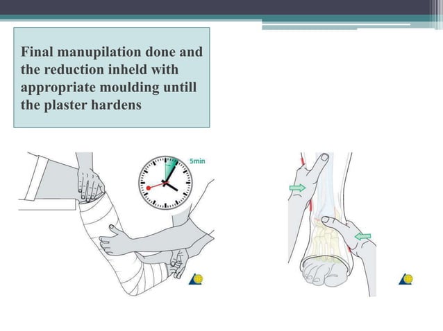 Plaster of paris ,synthetic casts and Functional cast bracing | PPTX