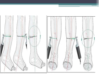 Plaster of paris ,synthetic casts and Functional cast bracing | PPTX