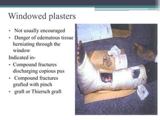 Plaster of paris ,synthetic casts and Functional cast bracing | PPTX