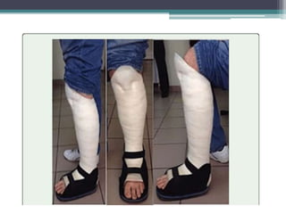 Plaster of paris ,synthetic casts and Functional cast bracing | PPTX