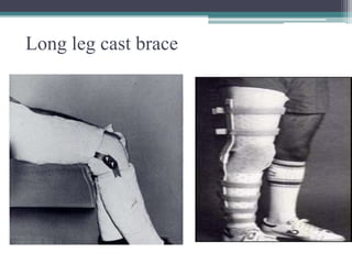 Plaster of paris ,synthetic casts and Functional cast bracing | PPTX