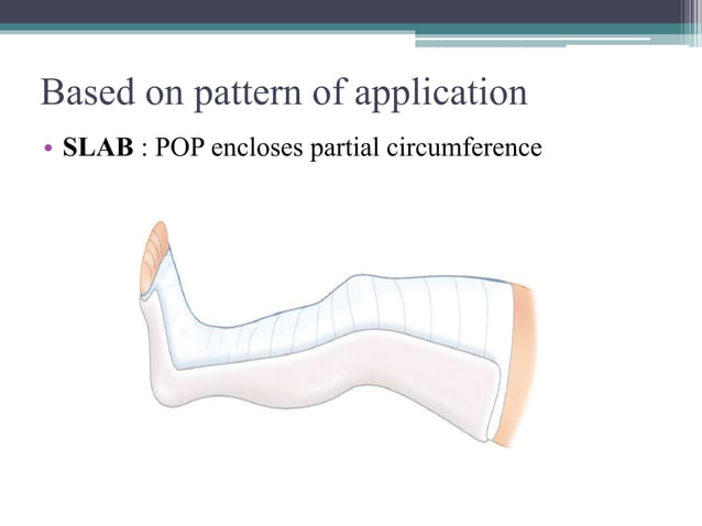 Plaster of paris ,synthetic casts and Functional cast bracing | PPTX