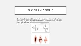 Plastias en z, retraccion de cicatrices. principios de las cirugía ...