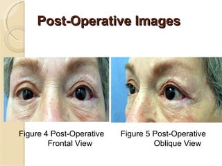 Periosteal Bone Flap Lateral Canthal Reconstruction | PPT