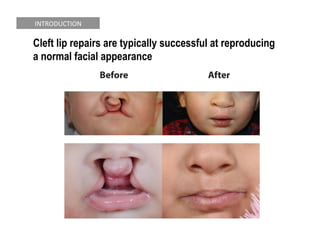 Helping plastic surgeons improve cleft palate surgery | PPT