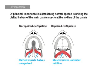 Helping plastic surgeons improve cleft palate surgery | PPT