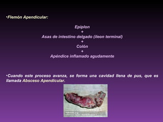 Plastron apendicular | PPT | Digestive Disorders | Diseases and Conditions