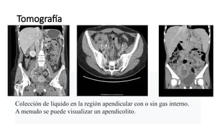 PLASTRON APENDICULAR EN PACIENTES PEDIATRICOS | PPTX