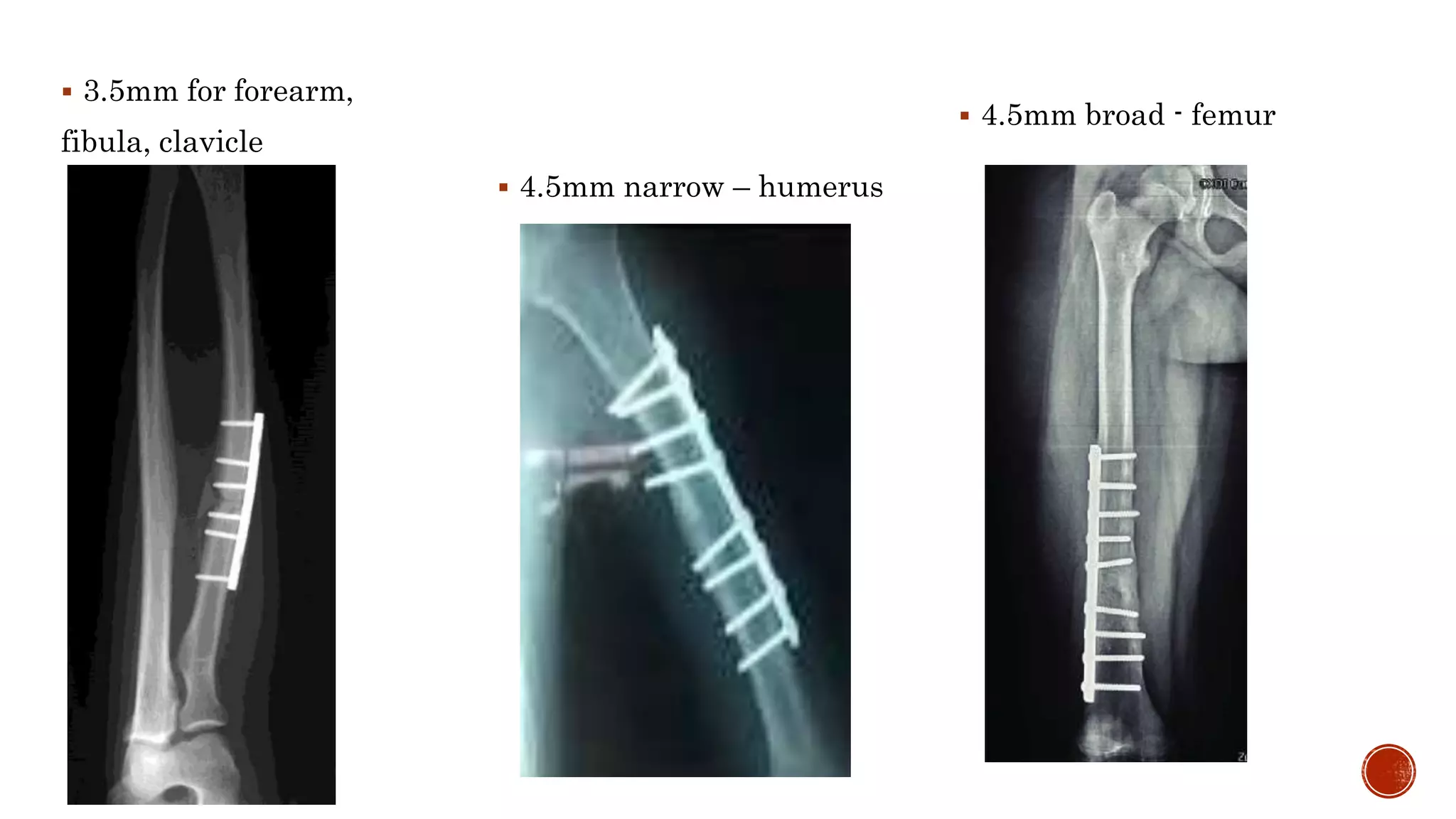 Orthopaedic Plates - types and applications | PPTX