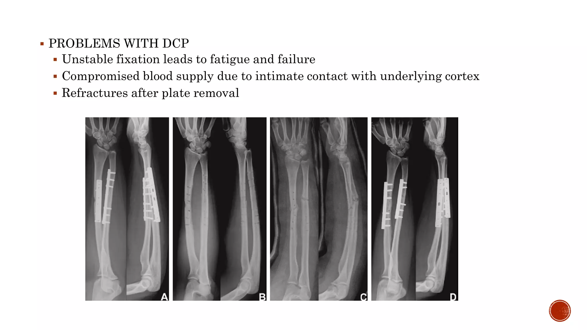 Orthopaedic Plates - types and applications | PPTX