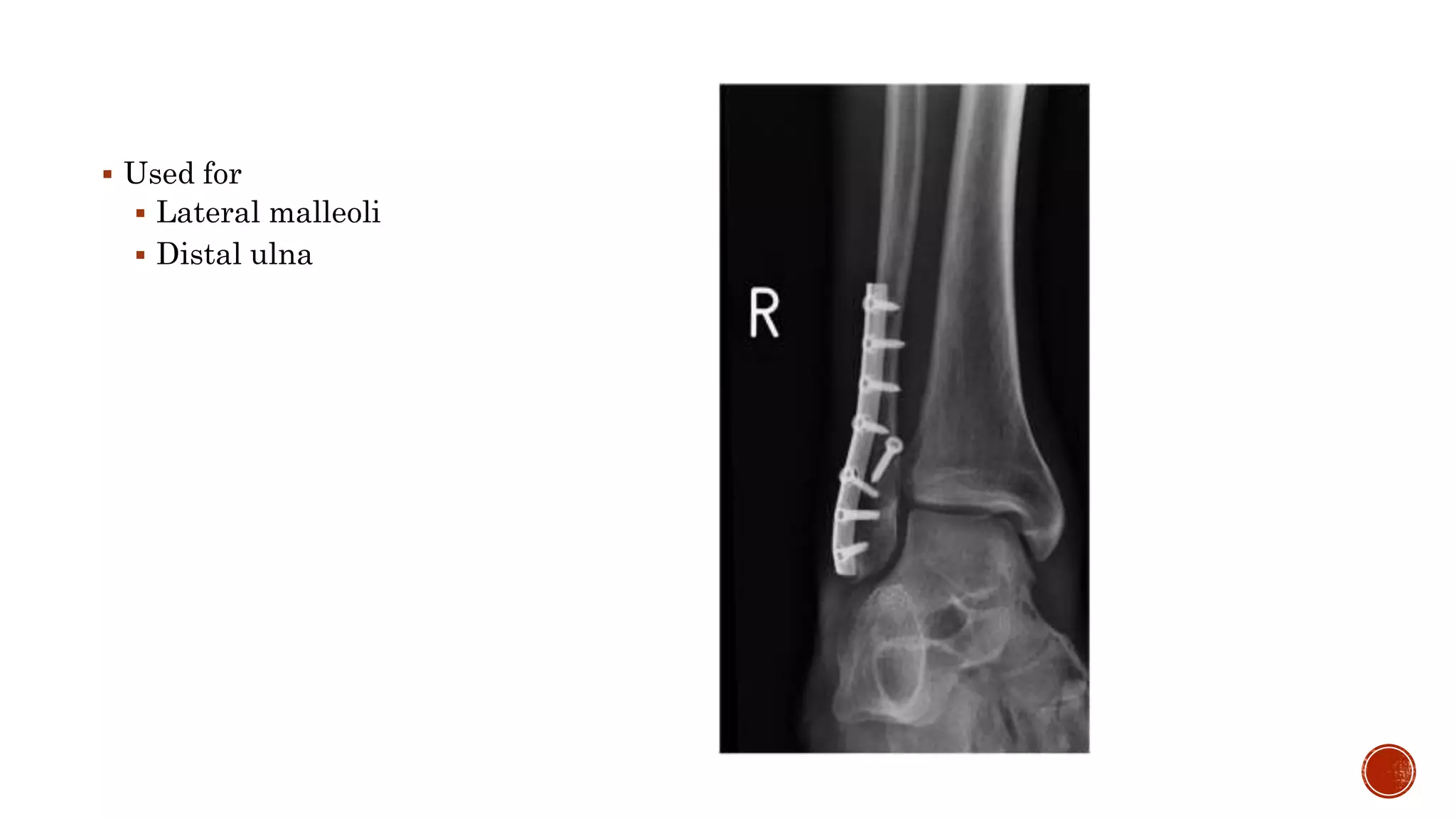 Orthopaedic Plates - types and applications | PPTX