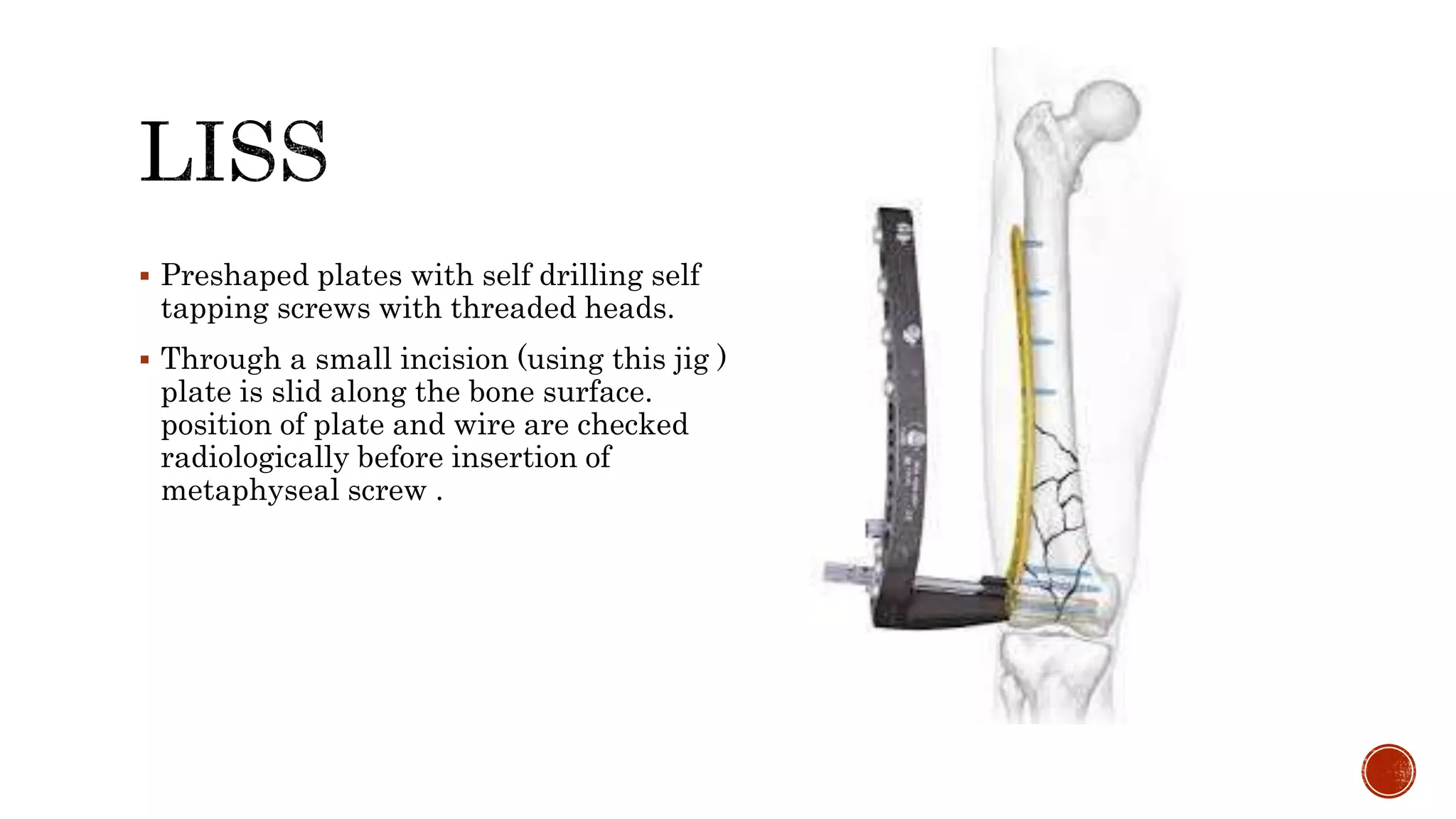 Orthopaedic Plates - types and applications | PPTX