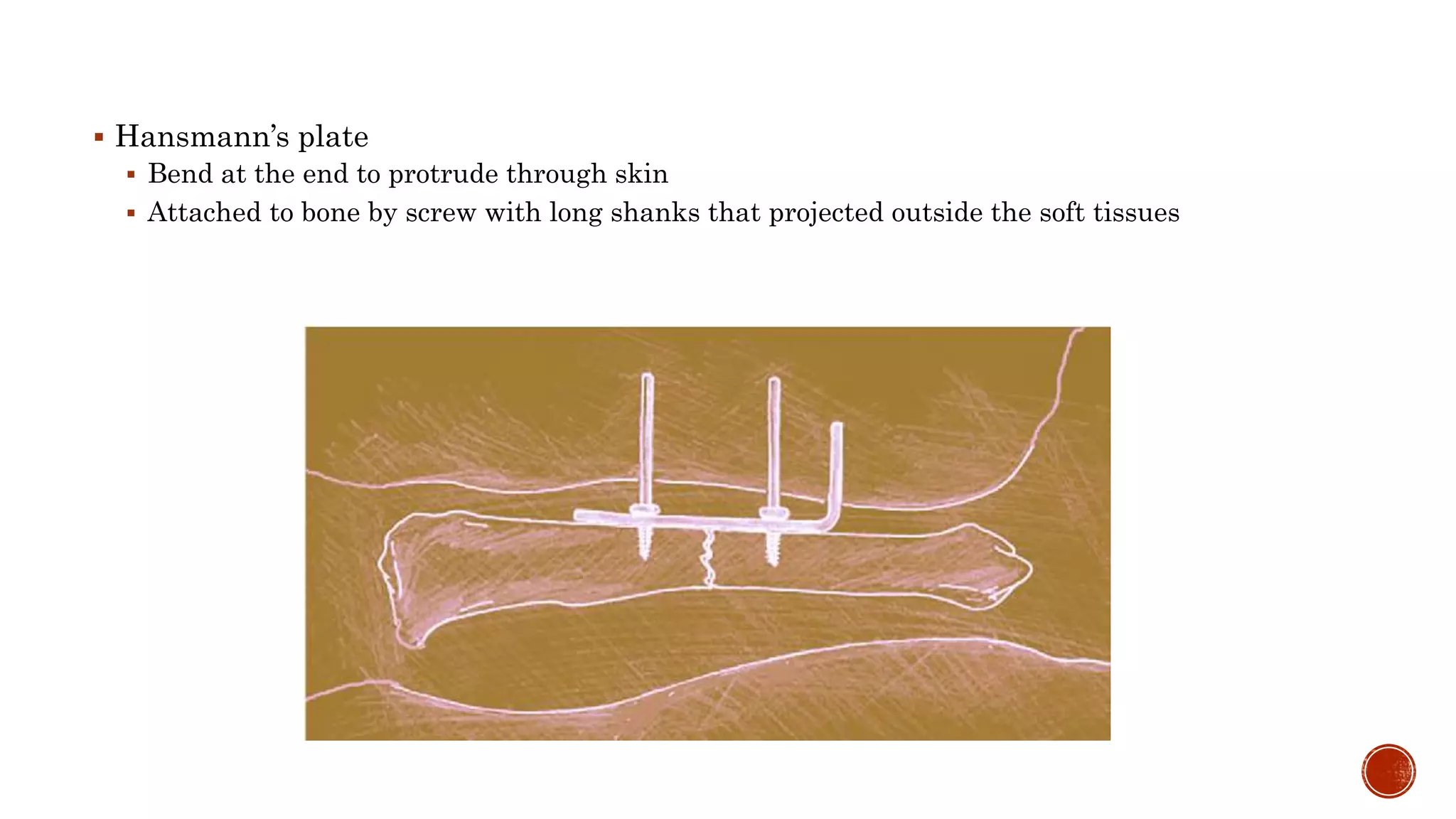 Orthopaedic Plates - types and applications | PPTX