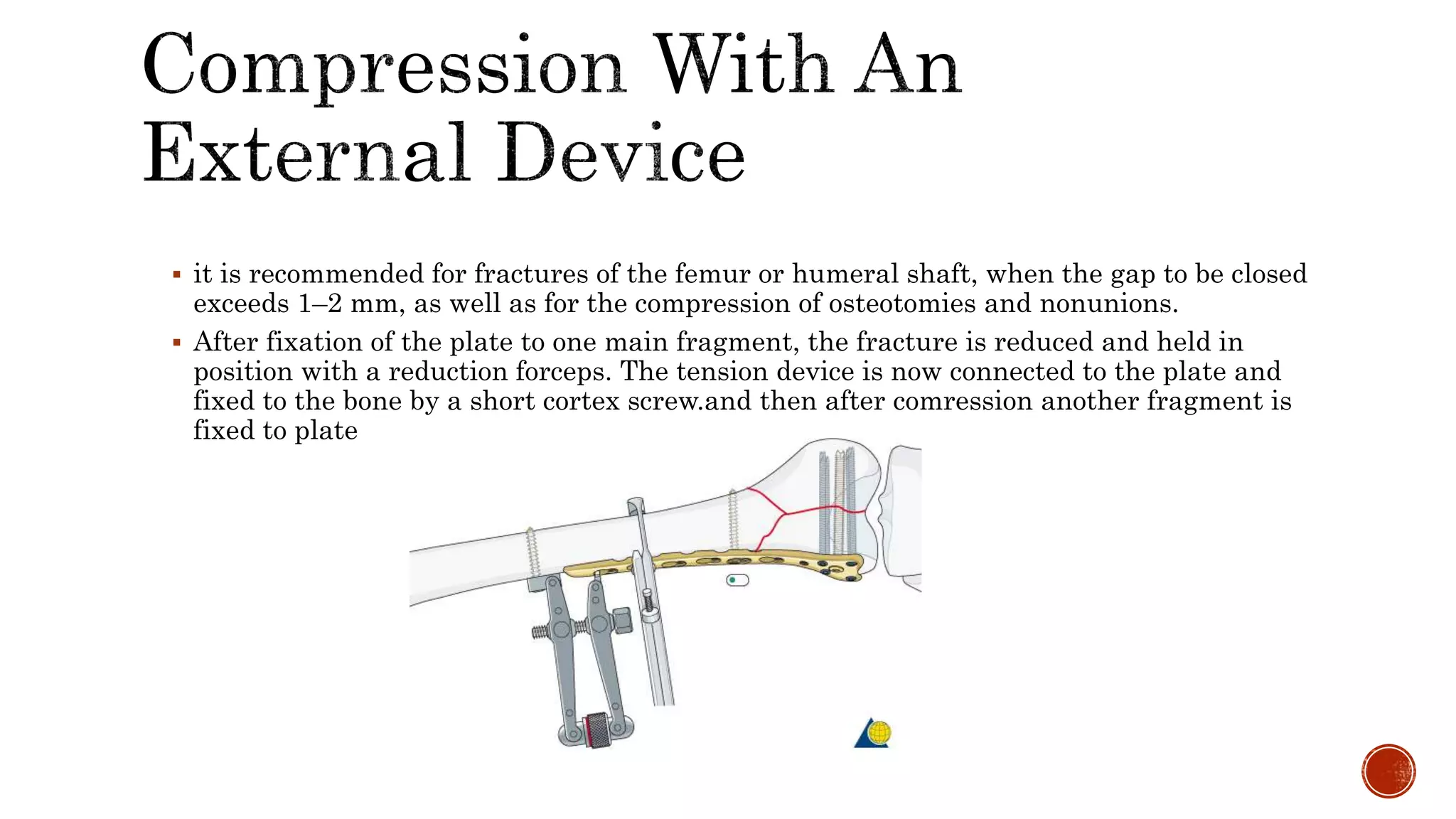 Orthopaedic Plates - types and applications | PPTX