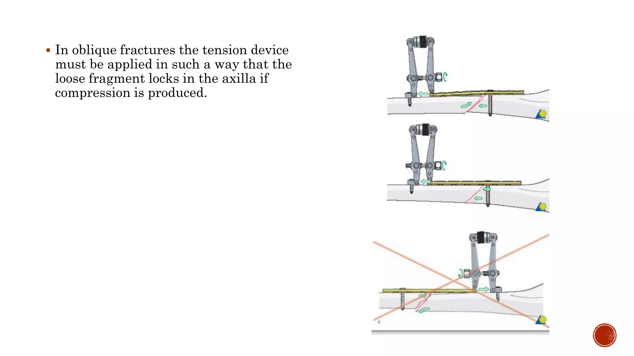 Orthopaedic Plates - types and applications | PPTX