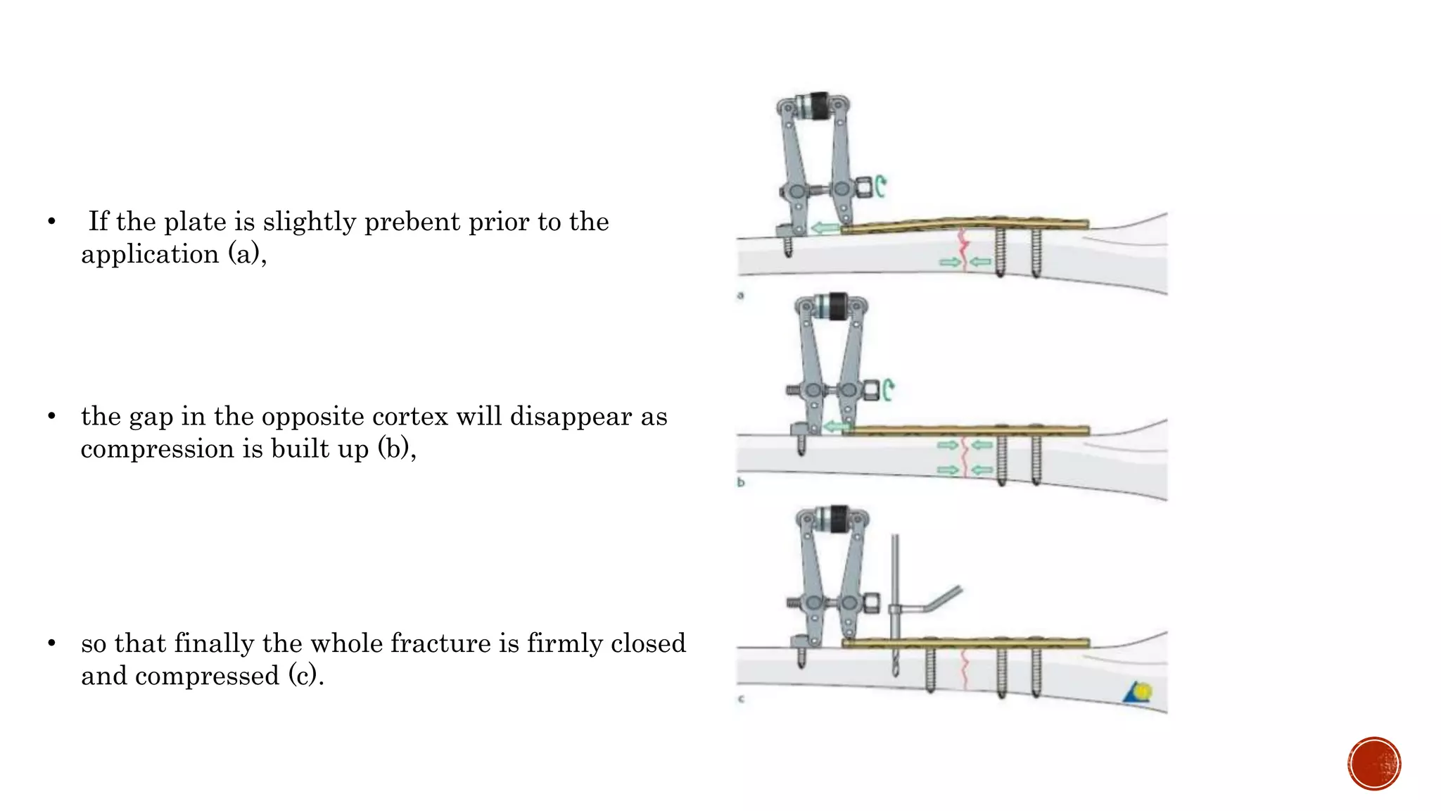 Orthopaedic Plates - types and applications | PPTX