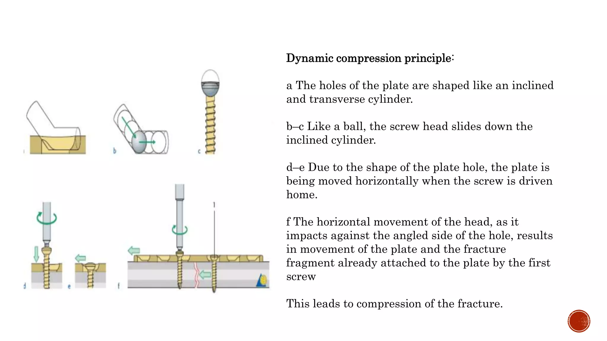 Orthopaedic Plates - types and applications | PPTX