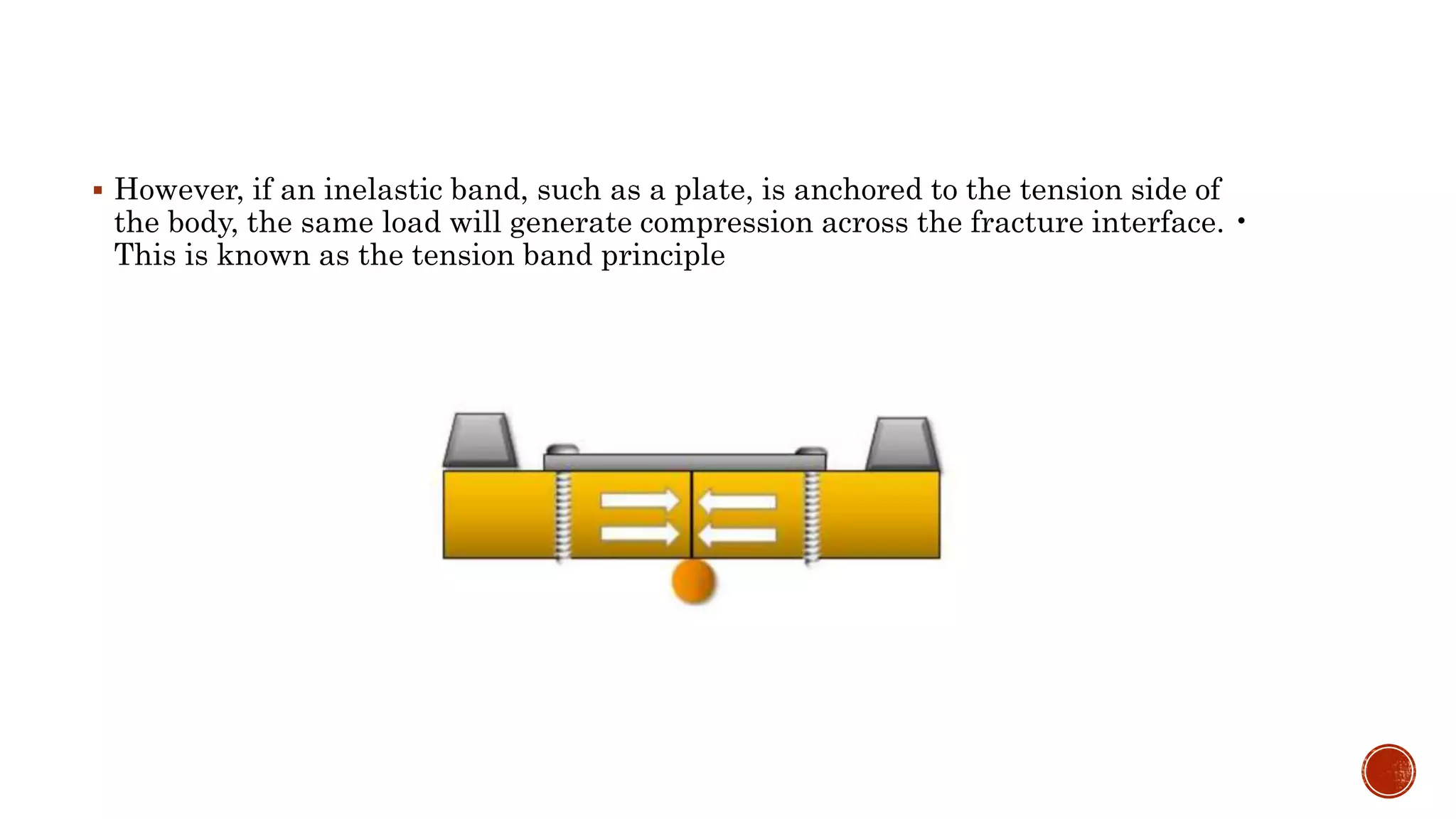 Orthopaedic Plates - types and applications | PPTX