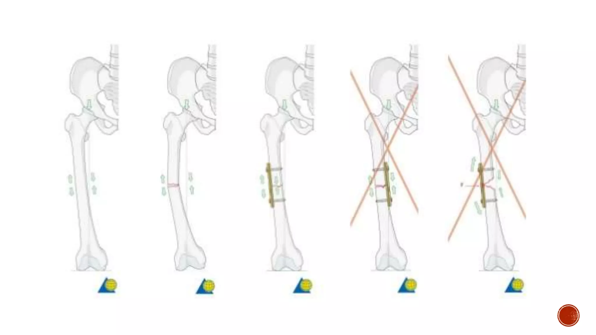 Orthopaedic Plates - types and applications | PPTX