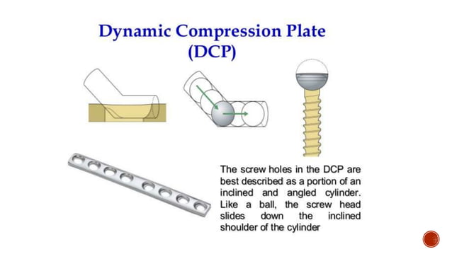 Orthopaedic Plates - types and applications | PPTX