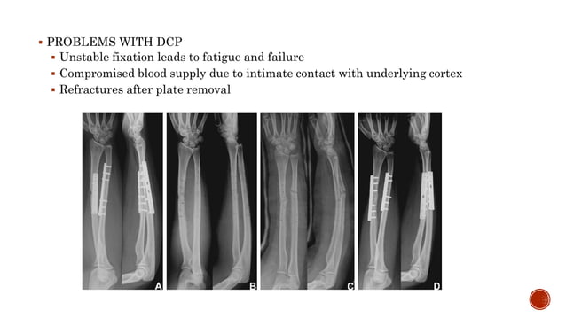 Orthopaedic Plates - types and applications | PPTX