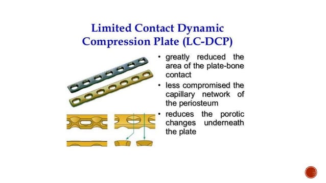 Orthopaedic Plates - types and applications | PPTX