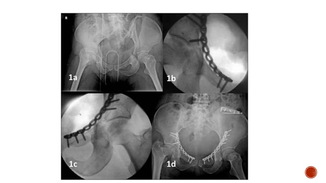 Orthopaedic Plates - types and applications | PPTX