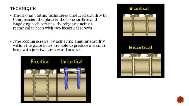 Orthopaedic Plates - types and applications | PPTX