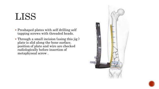 Orthopaedic Plates - types and applications | PPTX