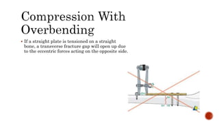 Orthopaedic Plates - types and applications | PPTX