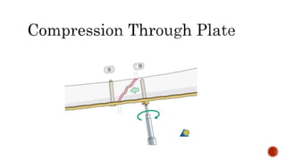 Orthopaedic Plates - types and applications | PPTX