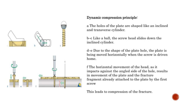 Orthopaedic Plates - types and applications | PPTX