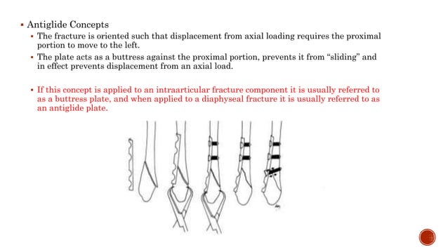 Orthopaedic Plates - types and applications | PPTX