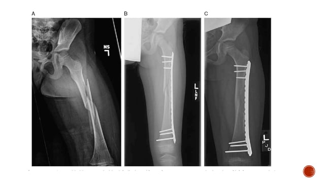 Orthopaedic Plates - types and applications | PPTX