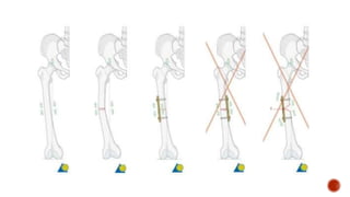 Orthopaedic Plates - types and applications | PPTX