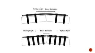 Orthopaedic Plates - types and applications | PPTX