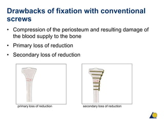 plate and screw AO.pptx