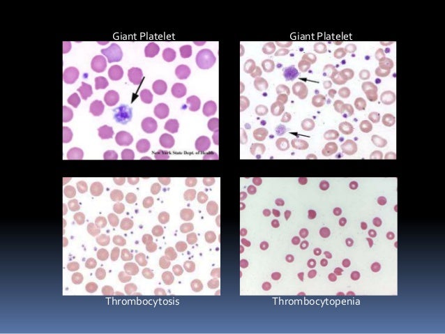 Platelet and coagulation disorder