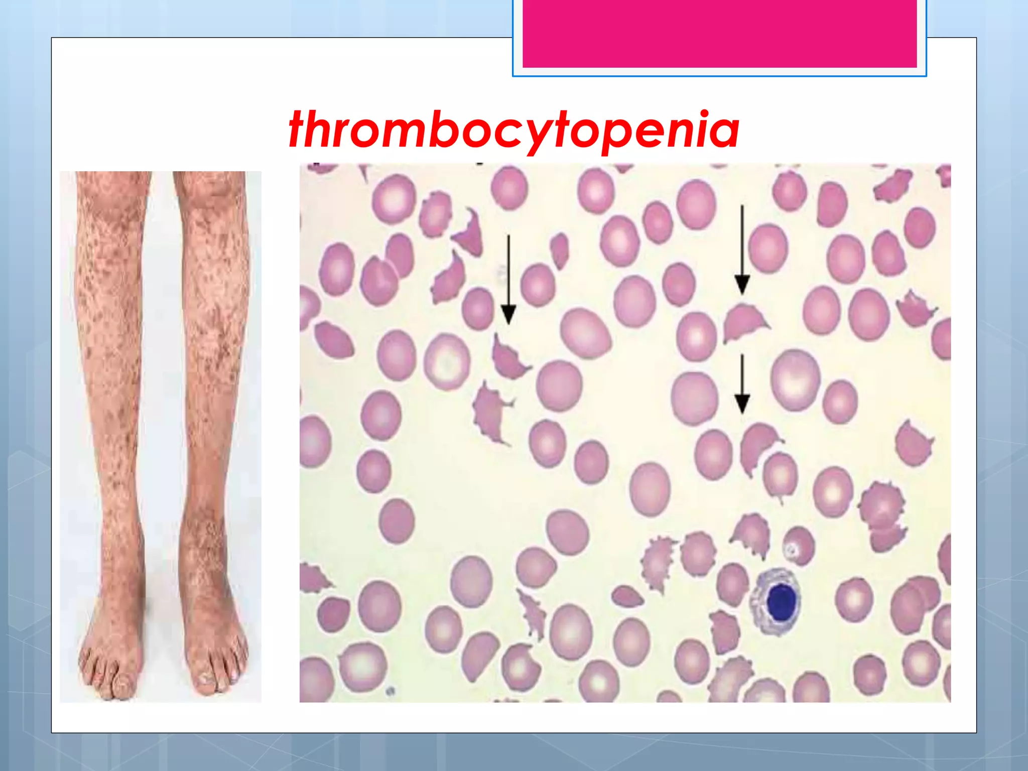 Platelet disorders | PPTX