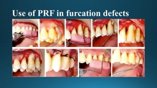 Platelet-rich fibrin (PRF) or leukocyte- and platelet-rich fibrin (L ...