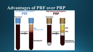 Platelet-rich fibrin (PRF) or leukocyte- and platelet-rich fibrin (L ...