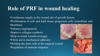Platelet-rich fibrin (PRF) or leukocyte- and platelet-rich fibrin (L ...