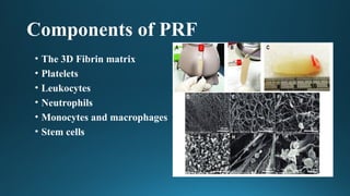 Platelet-rich fibrin (PRF) or leukocyte- and platelet-rich fibrin (L ...