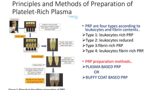Platelet rich plasma | PPTX