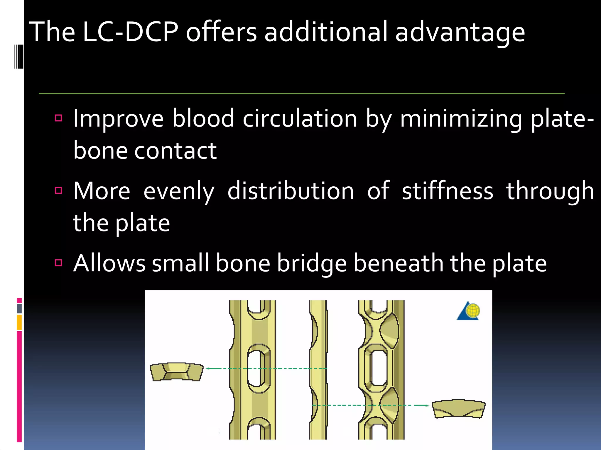 Plates and screws 11 | PPTX